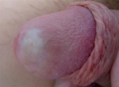 Les Dermatoses Du Gland Comment Prendre En Charge Une Balanite