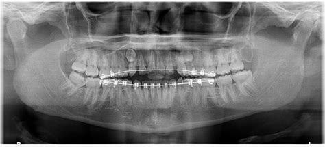 Supernumerary Teeth Extraction R Askdentists