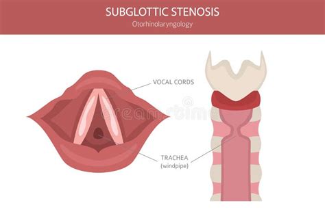 Subglottic Stenosis Diseases Pulmonology Otolaryngology Stock Vector