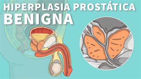 Hiperplasia Prostática Benigna Causas Síntomas Y Tratamiento Hpb