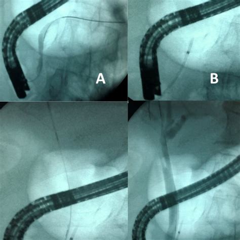 Mri Aspect Of The Periampullary Duodenal Diverticulum Download