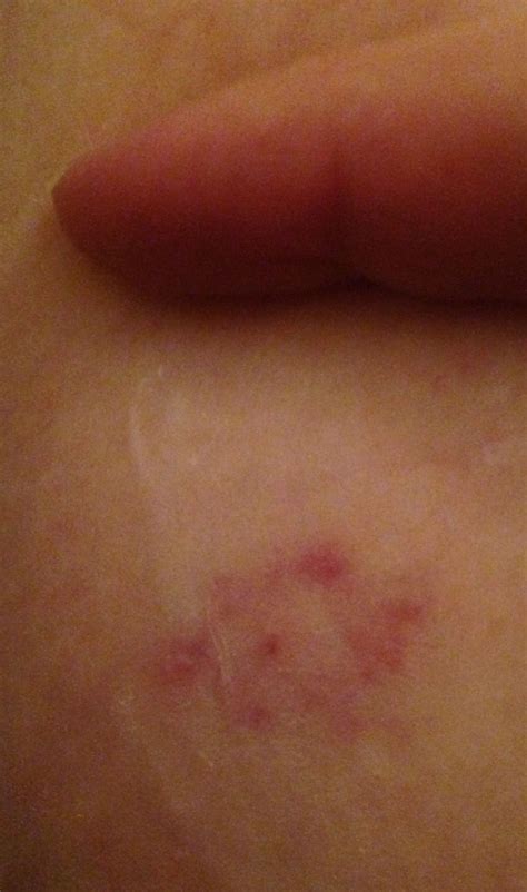 Muggenbult Allergie Of Tekenbeet Huisartsnl