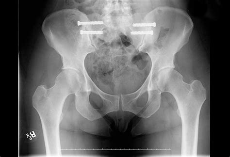 Si Joint Instability With Concurrent Piriformis Syndrome And Bi Lateral