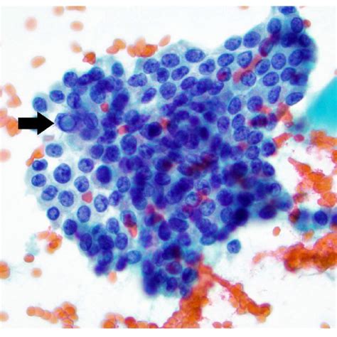 Thyroid Cytology By Fine Needle Aspiration Papanicolaou Pap Stain