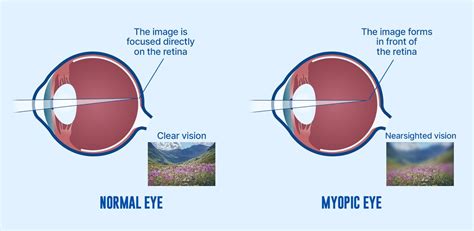Myopia Causes Solutions And The Best Lenses To Correct It Linsenmax