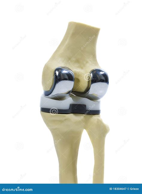 Plastic Model Of A Knee Replacement Stock Image Image Of Surgery
