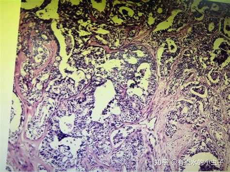 病理切片图 镜下 知乎