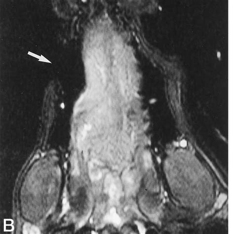 A Fast Spin Echo T2 Weighted Image 4000 99 4 Shows Severe Artifacts Download Scientific