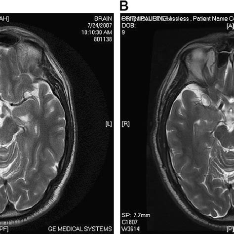 Imaging With Mri Shown At The Baseline Before Stem Cell Transplantation