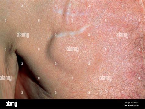 Pacemaker A Heart Pacemaker Implanted Under The Skin Below The