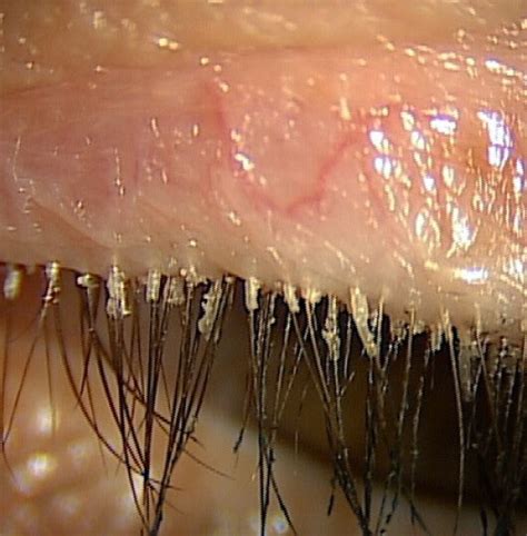 Discover Demodex Look At The Lids