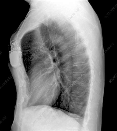 Pectus Excavatum Xray Chest X Ray As A Primary Modality For