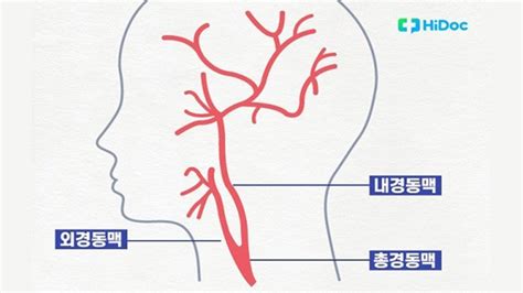고혈압∙당뇨 있다면 뇌졸중 예방 위해 이 검사 받아야 인터뷰