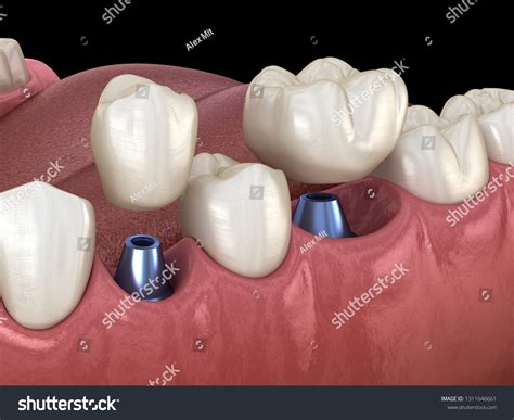 Premolar Molar Tooth Crown Installation Over Stock Illustration 1311646661