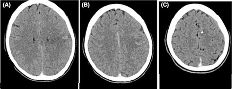 Brain Ct Scan Without And With Injection Left Parietal Hypodensity