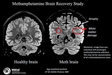 Can Brains Bounce Back Recovering Addicts Turn To Science To Map The