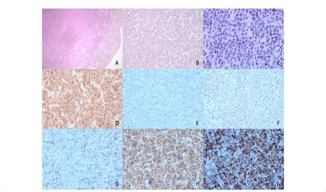 Histopathological Features Of Plasma Cell Neoplasm With Pleomorphic