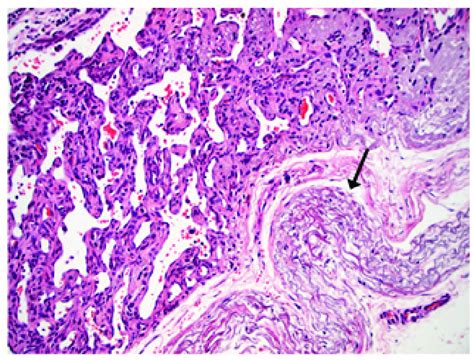 Hande Photomicrograph 100× Magnification Of Case 2 Bulbar Conjunctival