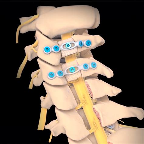 Spinal Decompression Surgery Laminoplasty At Drhc Dubai