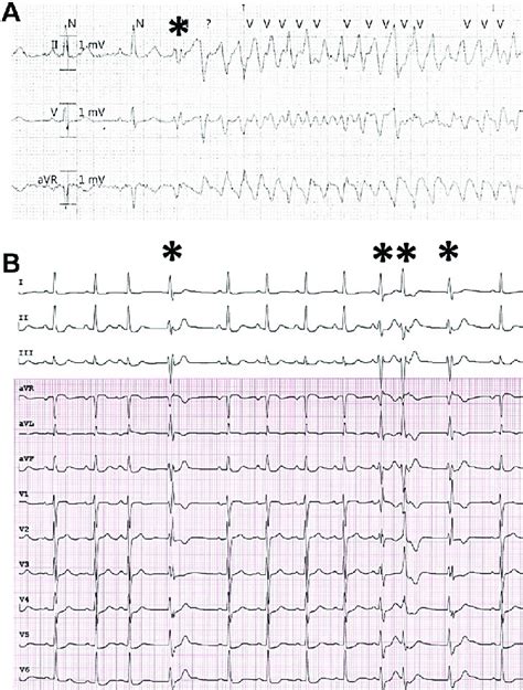 A Telemetry Tracing Shows An Episode Of Sustained Polymorphic