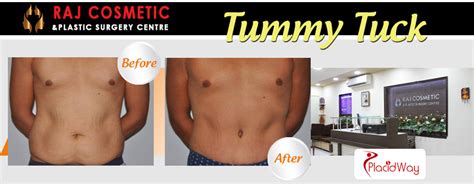 Before And After Tummy Tuck Chennai India