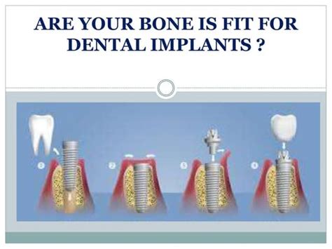 Dental Implants Ppt