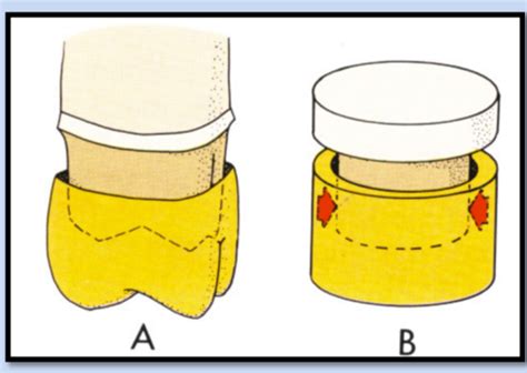 Basic Principles Of Tooth Prep 1 Flashcards Quizlet
