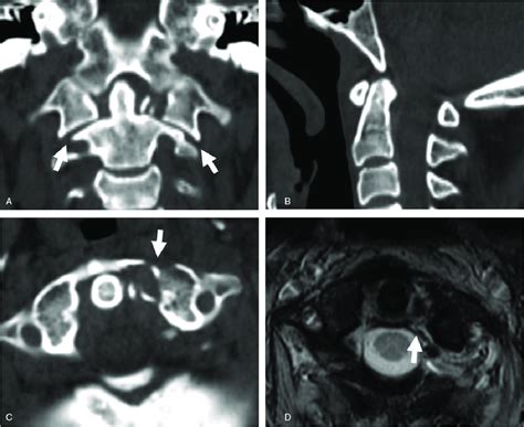 Unilateral Sagittal Split Fracture With Transverse Atlantal Ligament