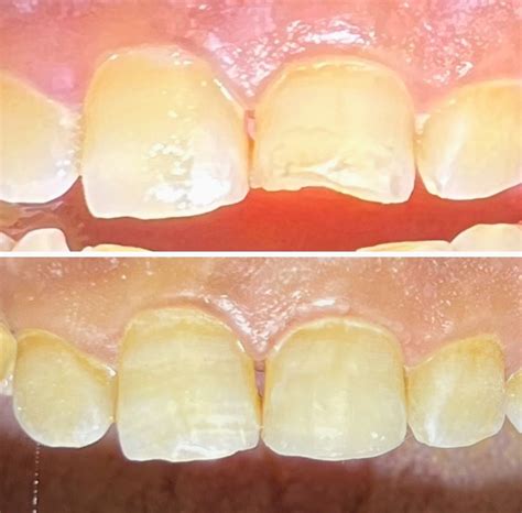 Muhammad Walid On Linkedin Polychromatic Layering Composite 🦷🎨 Class Iv Ul1