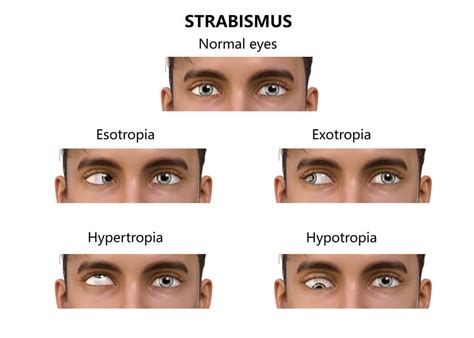 Adult Strabismus St Paul Crossed Eyes Eye Misalignment