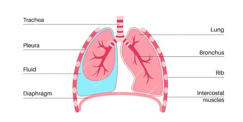 Premium Vector Pleural Effusion Poster
