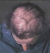 Diffuse Patterned Alopecia DPA Diffuse Unpatterned Alope In Karnal ID