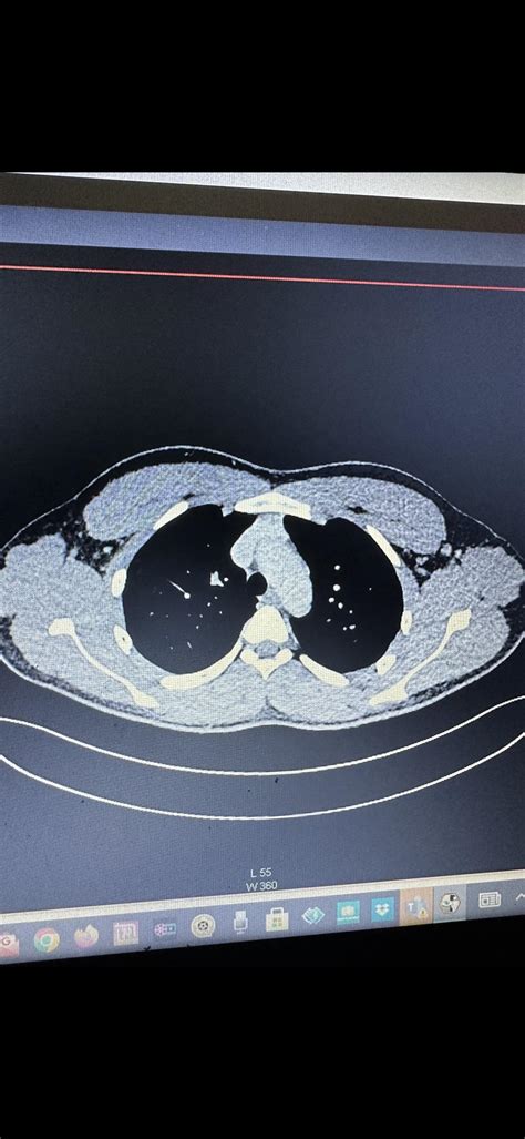 Ct Thymic Tissue R Medical