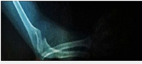 Case One Evidence Of Posterior Dislocation Of The Radial Head As Seen