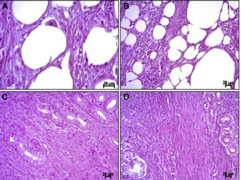 E Histopathologic Evaluation Of Adhered Tissues A Giant Cell
