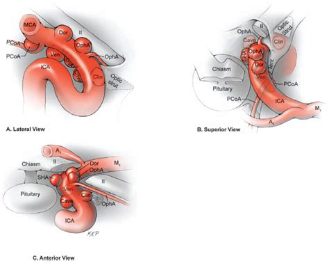Ophthalmic Artery Aneurysms Neupsy Key