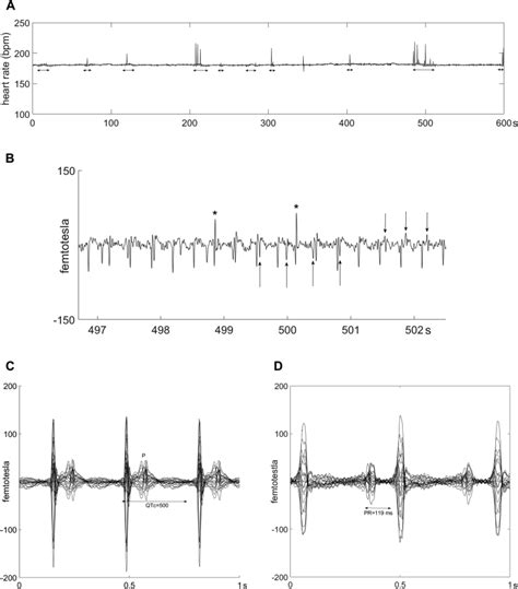 Prenatal Diagnosis And Management Of Junctional Ectopic Tachycardia Pmc
