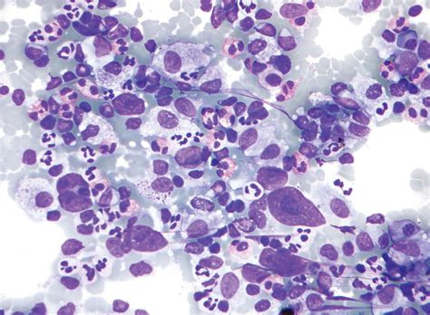 Hodgkin Lymphoma Description Causes Symptoms And Treatment Britannica