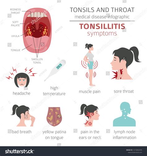 Tonsils Throat Diseases Tonsillitis Symptoms Treatment Stock Vector