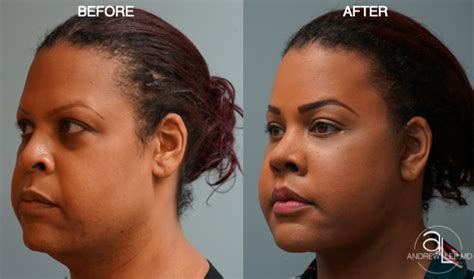 Cheek Implants Dr Andrew H Lee