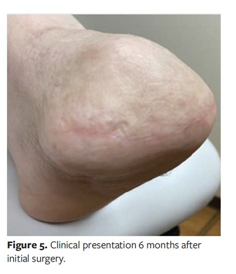 Necrotizing Fasciitis Due To Streptococcus Constellatus In A Patient