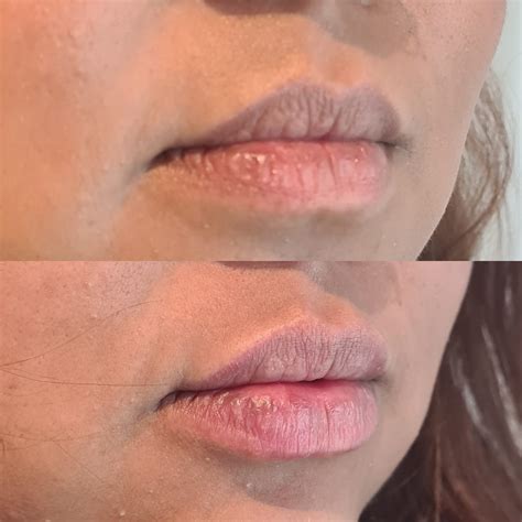 Best Lip Fillers Clinic Near Me Lip Injections Enhancements