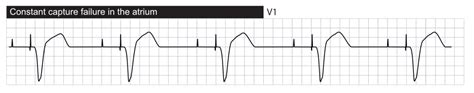 Assessment Of Pacemaker Malfunction