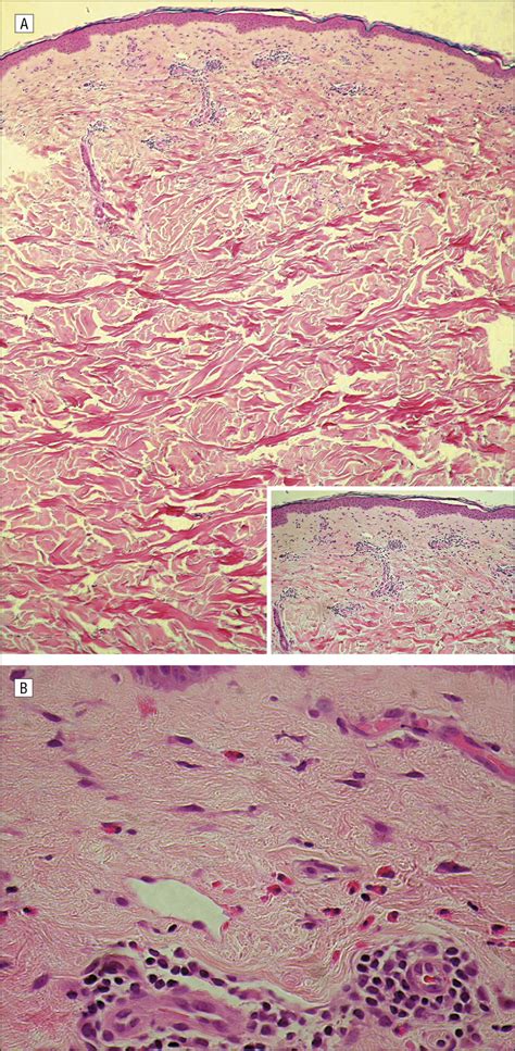 Defining Urticarial Dermatitis A Subset Of Dermal Hypersensitivity