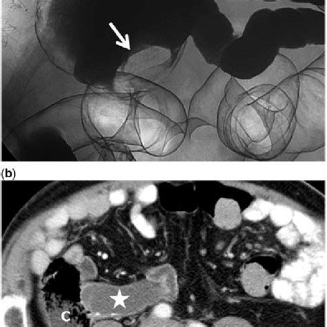 A 78 Year Old Asymptomatic Man With Mucinous Adenoma Of The Appendix Download Scientific