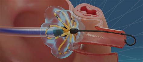 Farapulse™ Pulsed Field Ablation System Cardioplus