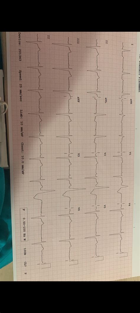 Is This Left Bundle Branch Block R Ekgs