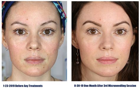 Microneedling Before And Afters 3 Treatments So Far Life And Diy