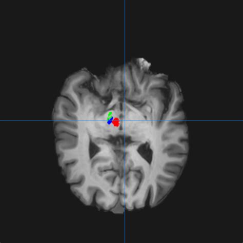 Registered T 1 Weighted Mri Of A Human Brain Areas Depicted