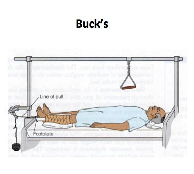 Bucks Traction
